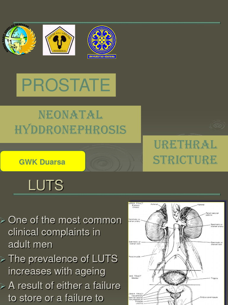 Lecture 15-16. BPH, Stricture Urethra, Varicocele, Spermatocele, Neonatal Hidronefrosis | PDF ...
