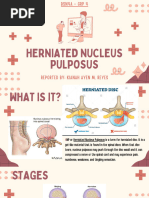 Understanding Herniated Nucleus Pulposus | PDF | Vertebral Column ...