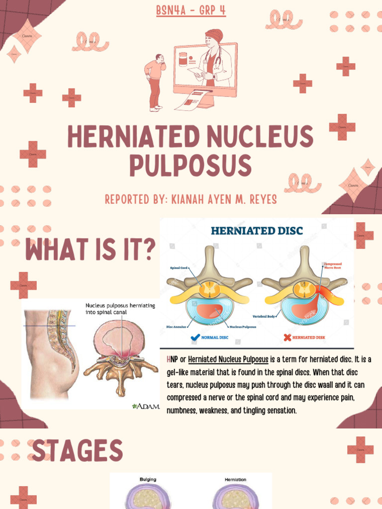 HNP | PDF | Nervous System | Clinical Medicine