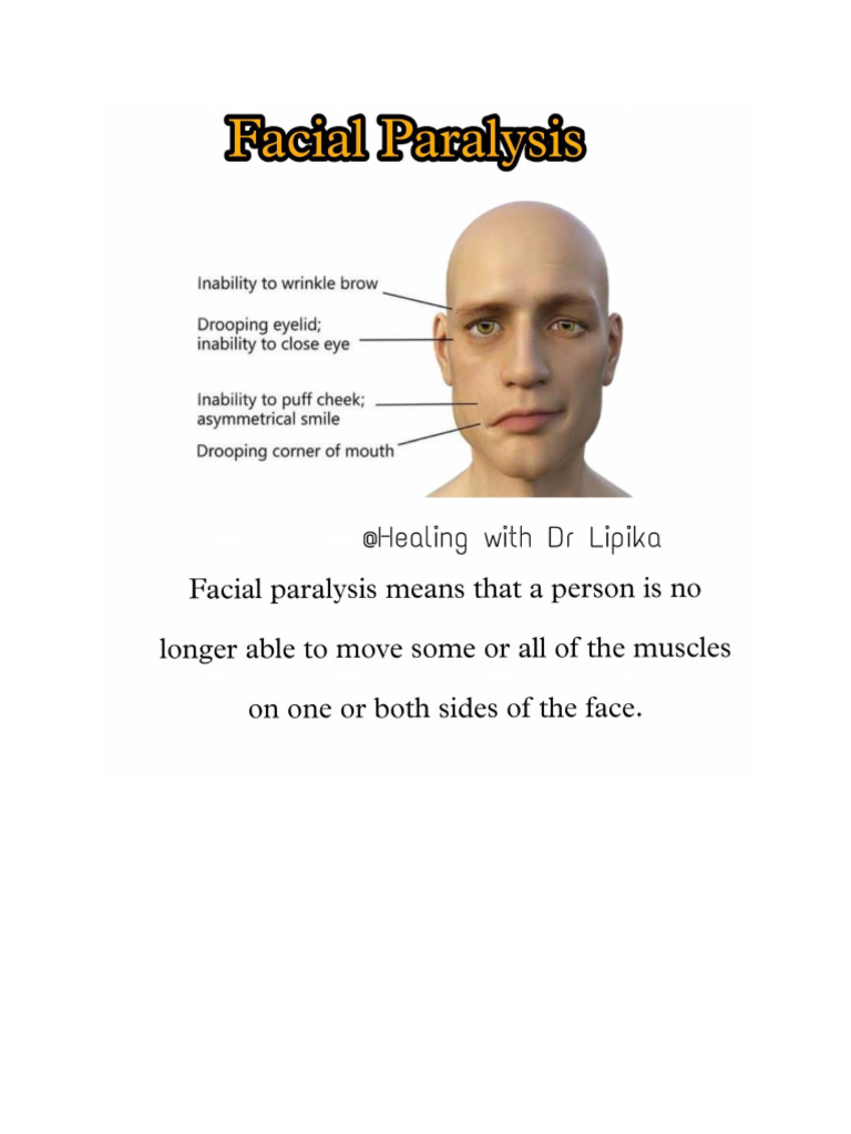 Facial Paralysis | PDF