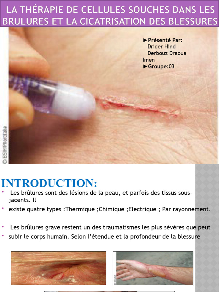 Csti Exposé | PDF | Brûlure | Peau