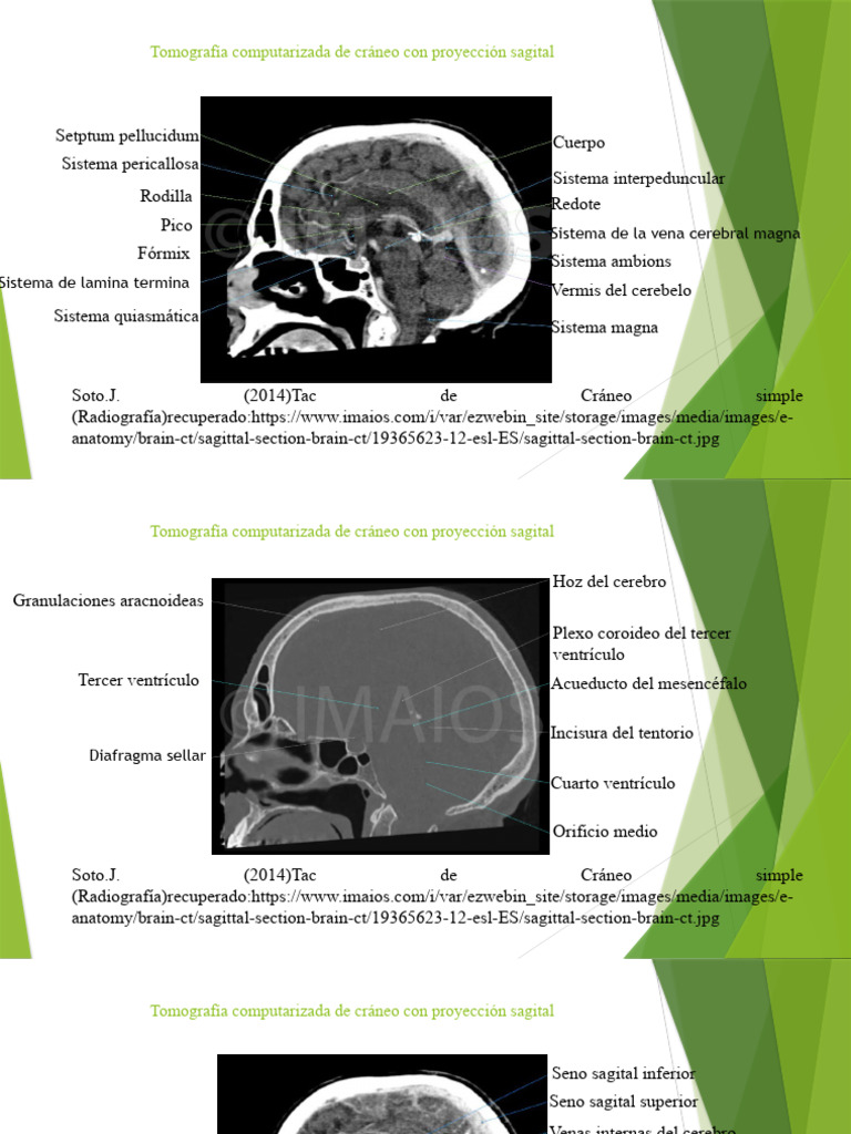 Tomografía Computarizada de Cráneo Con Proyección Coronal | PDF ...
