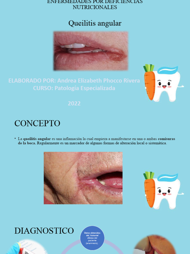 Queilitis Angular | PDF | Vitamina a | Vitamina