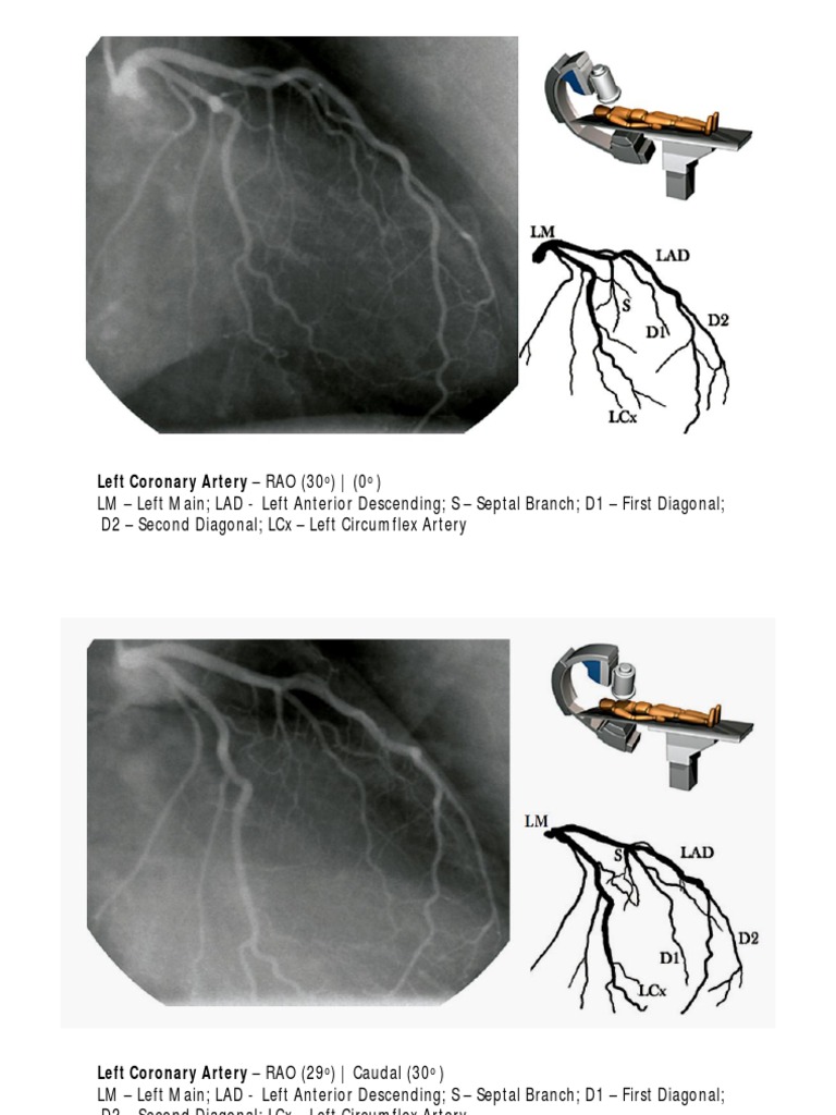 Coronary Angiography Pdf