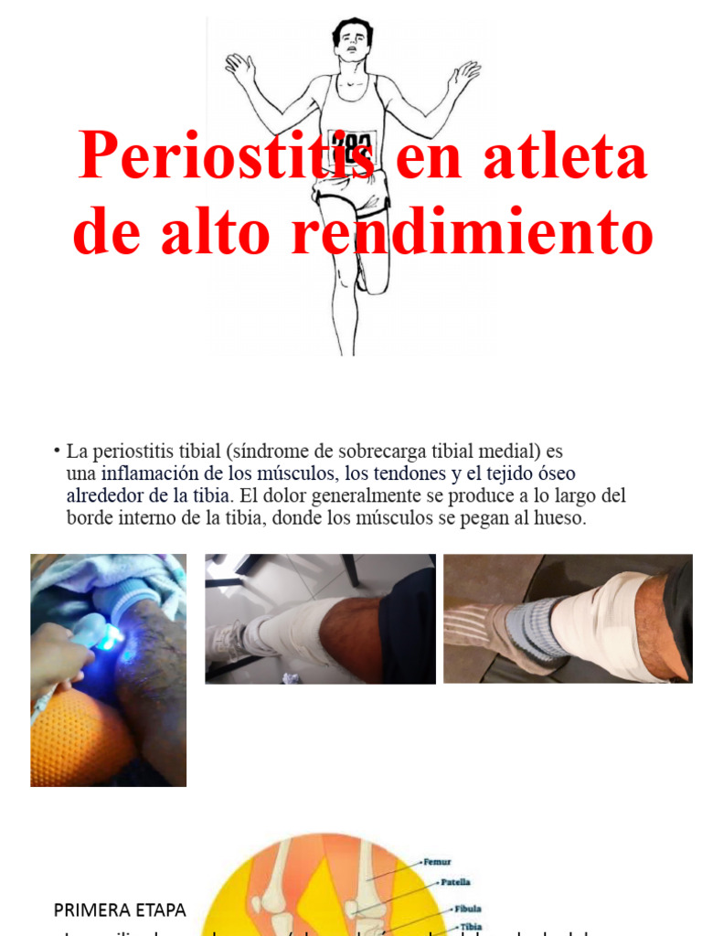 Tratamiento de Periostitis en Atletas | PDF