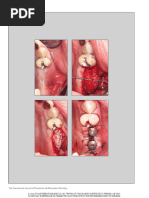 Miller Classification of Tissue Recession | PDF | Periodontology ...
