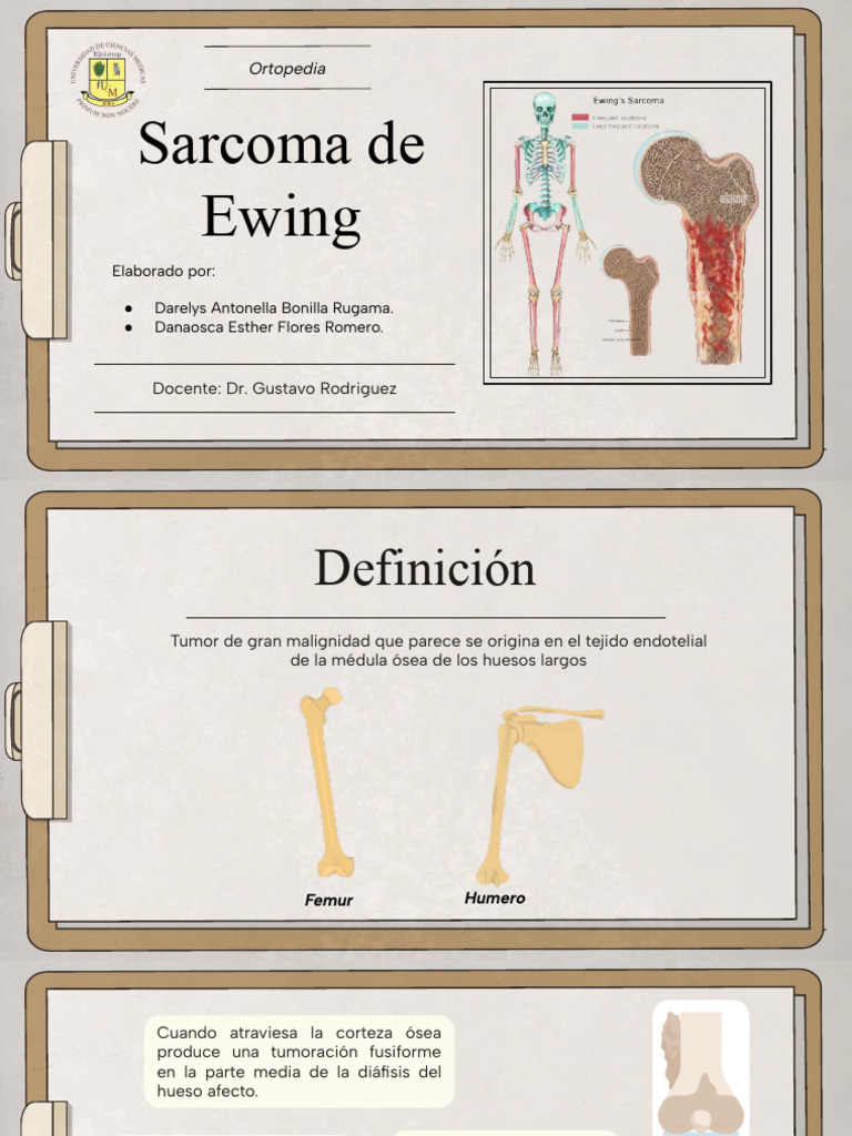 Sarcoma de Ewing | PDF | Sarcoma | Hueso