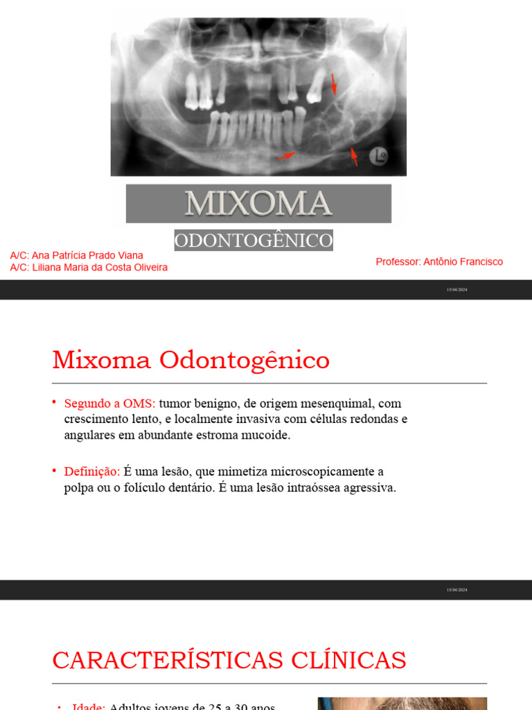 Mixoma Odontogênico | PDF | Neoplasmas | Causas de morte