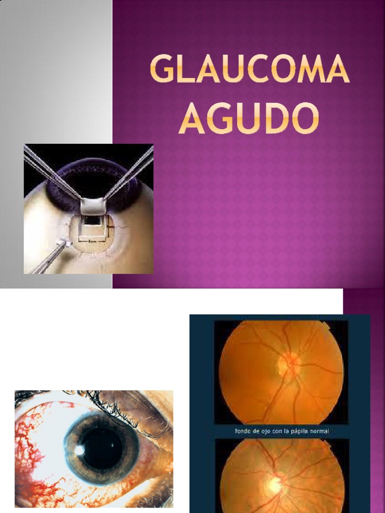 Glaucoma Agudo | Ojo humano | Córnea