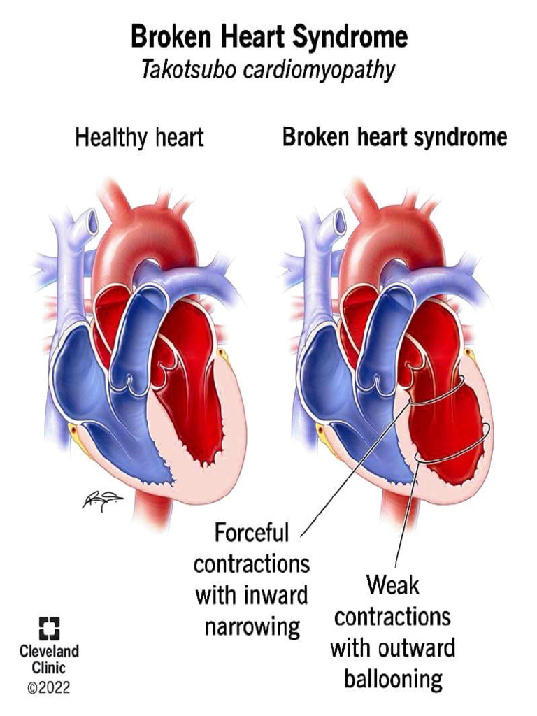 Understanding Broken Heart Syndrome | PDF