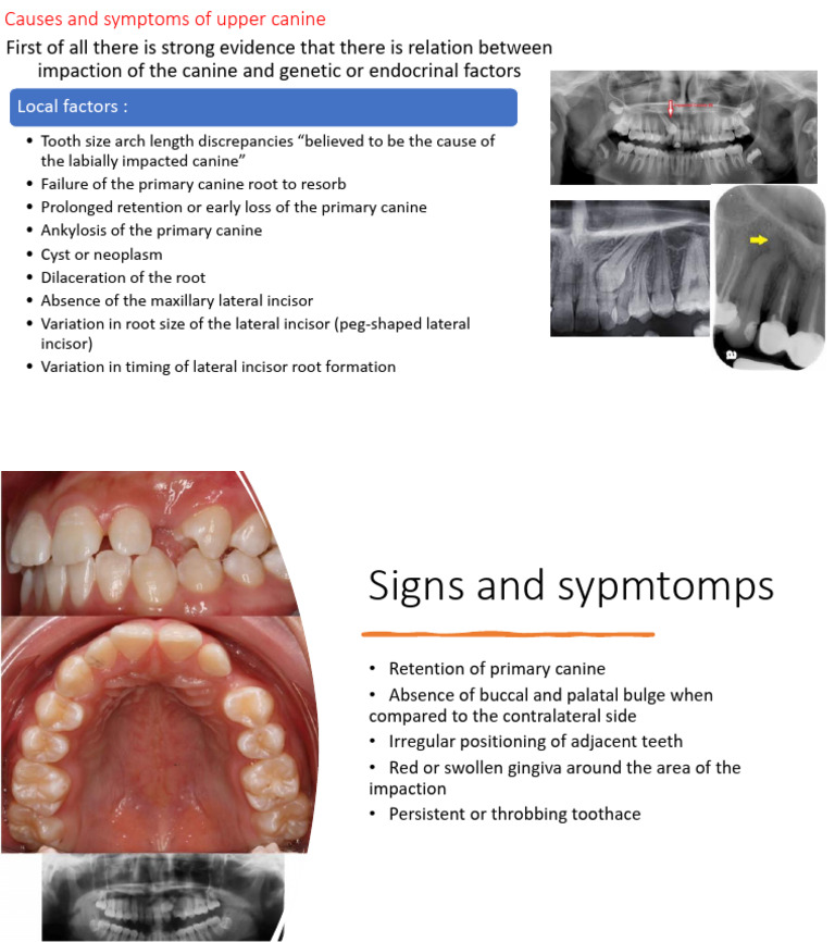 Upper Canine Impaction Causes & Symptoms | PDF | Home & Garden