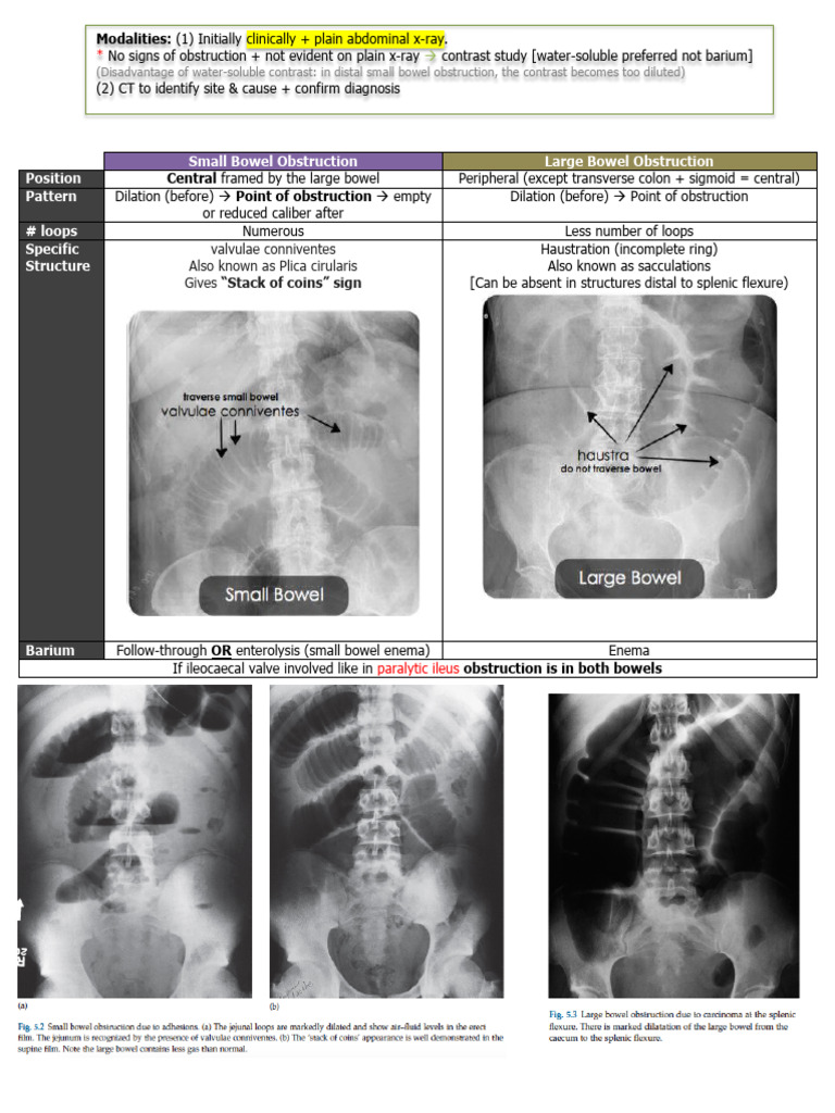 Small Vs Large Bowel Obstruction-2 | PDF