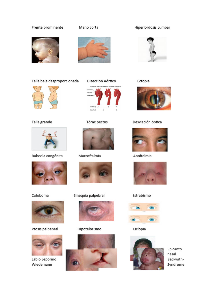 Frente Prominente Mano Corta Hiperlordosis Lumbar | PDF