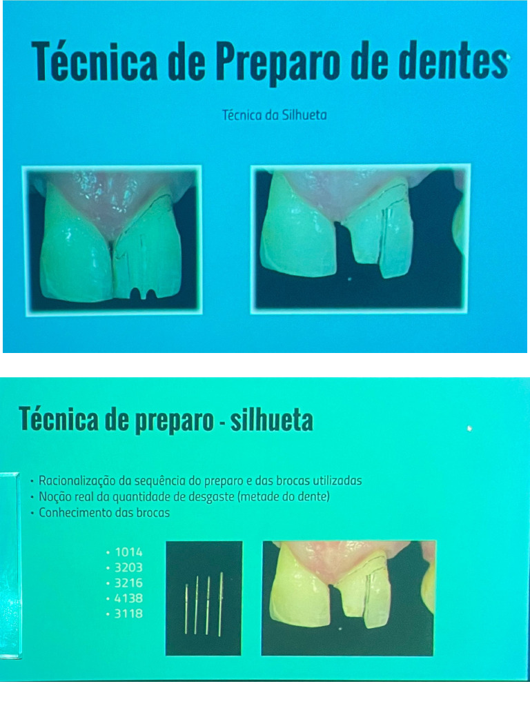 Técnica de Preparo de Dentes | PDF