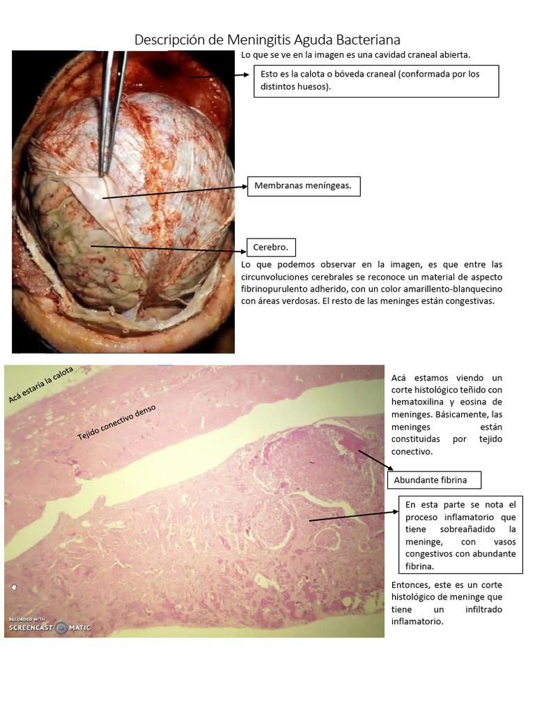 Descripción de Meningitis Aguda Bacteriana | Descargar gratis PDF ...