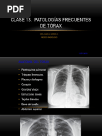 Radiología de Tórax - Patrones Básicos | PDF | Pulmón | Pecho