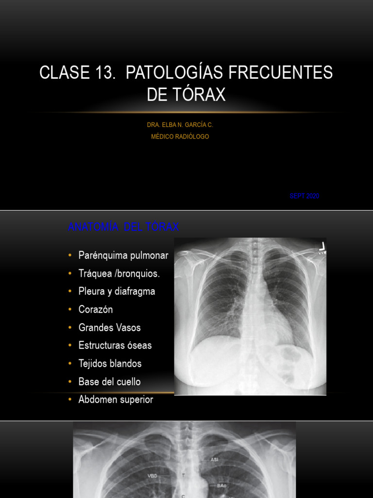 Clase 13 Patologías Frecuentes Del Tórax. | PDF | Pulmón | Tórax
