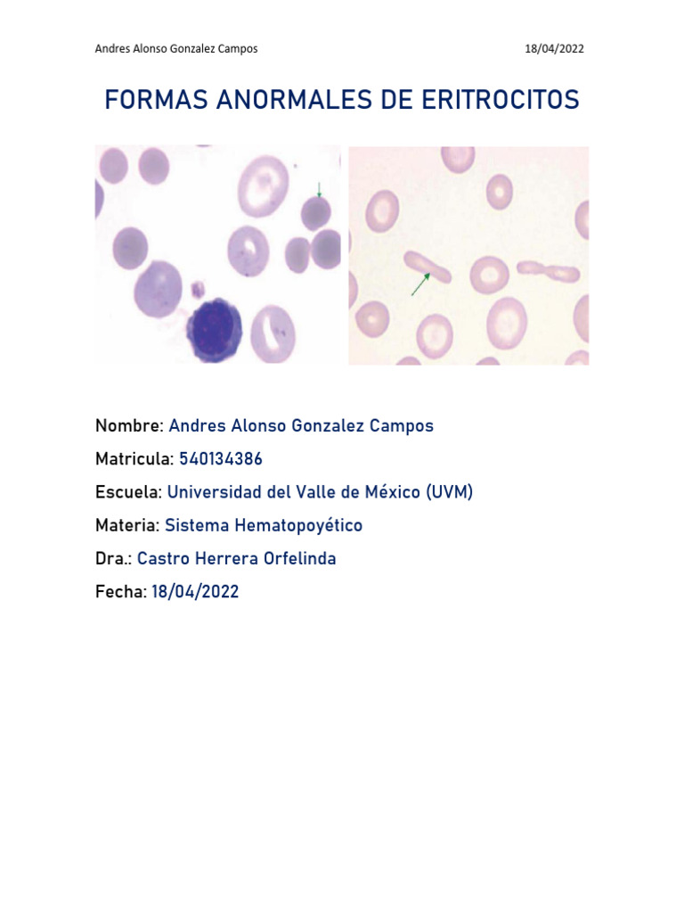 Formas Anormales de Eritrocitos | PDF | Glóbulo rojo | Anemia