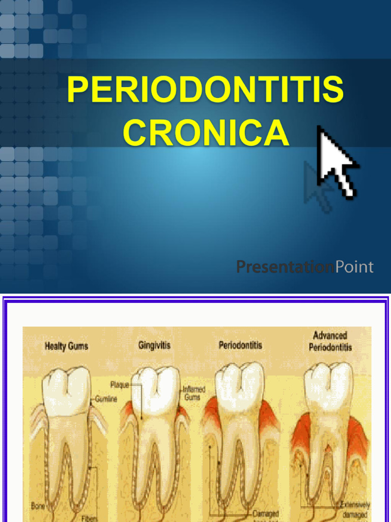periodontitis cronica | PDF | Salud pública | Boca
