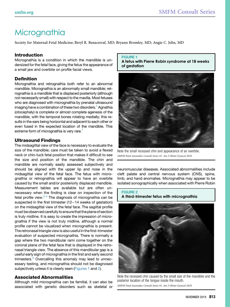 Micrognathia | PDF | Pregnancy | Fetus