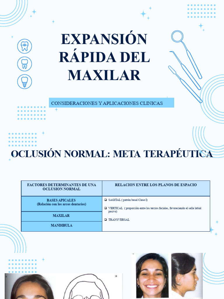 Expansion Rapida Del Maxilar | PDF | Dolor | Ortodoncia Expansion Rapida Del Maxilar | PDF | Dolor | Ortodoncia