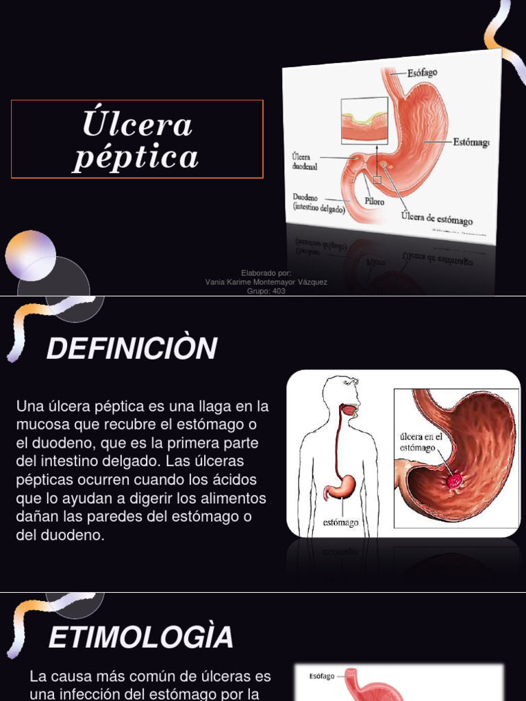Definición y Tratamiento de Úlceras Pépticas | PDF | Medicina CLINICA ...