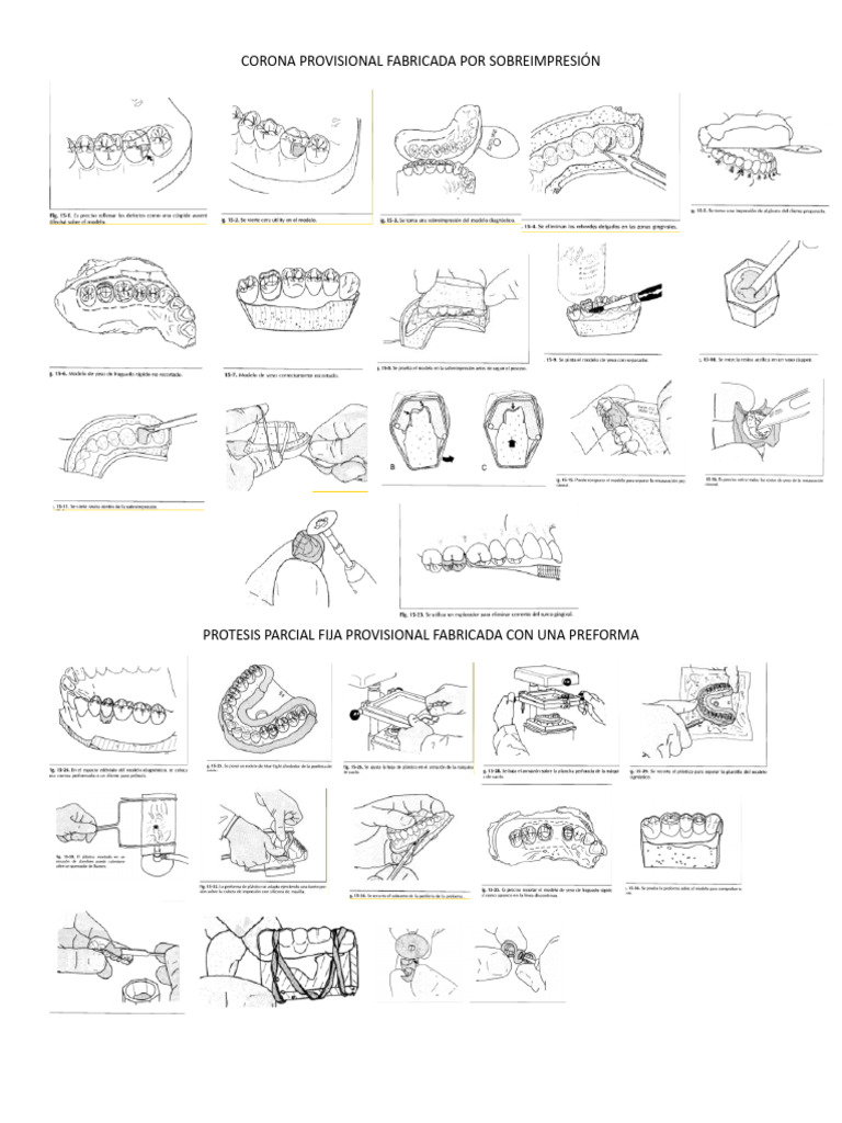 Tipos de Coronas Provisionales Dentales | PDF