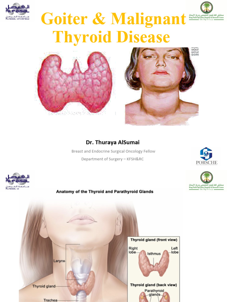 Goiter and Malignant Thyroid Disease | Download Free PDF | Thyroid ...