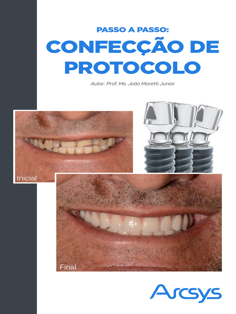Protocolo Inferior Joao - Moretti | PDF | Prótese