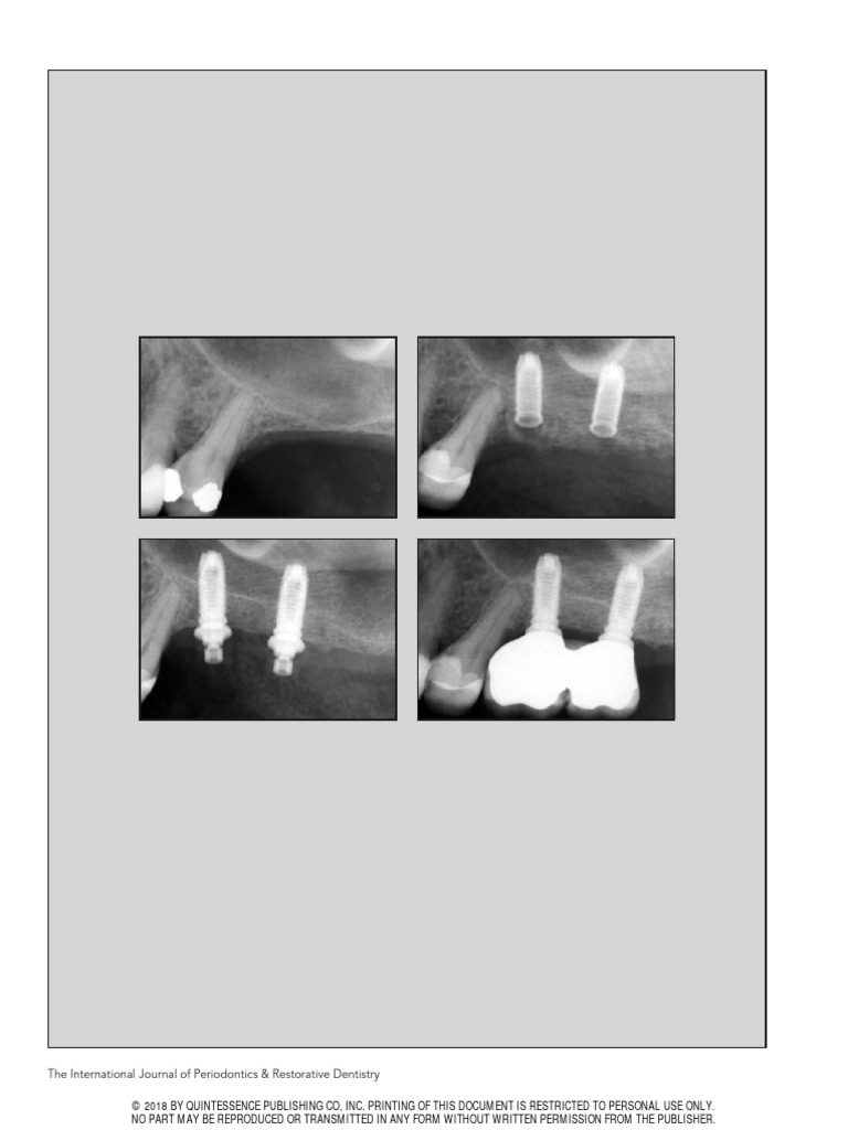 Three-Dimensional Bone Augmentation and Immediate Implant Placement Via Transcrestal Sinus Lift ...
