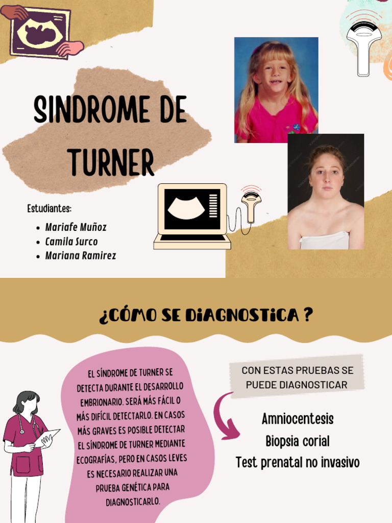 SEM. 1 -SINDROME DE TURNER (1) | PDF | Especialidades Medicas ...