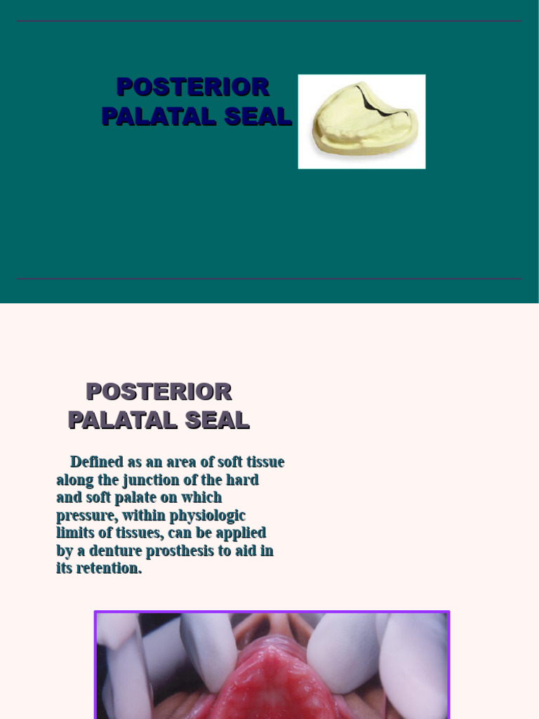 Posterior Palatal Seal | PDF | Dentures | Anatomical Terms Of Location