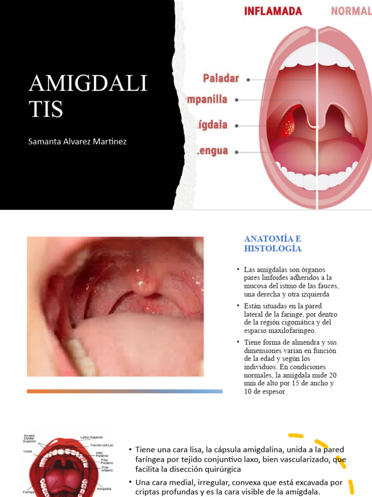 AMIGDALITIS | PDF | Linfocitos | Anatomía