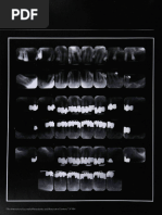 Miller Classification of Marginal Tissue | PDF | Periodontology ...