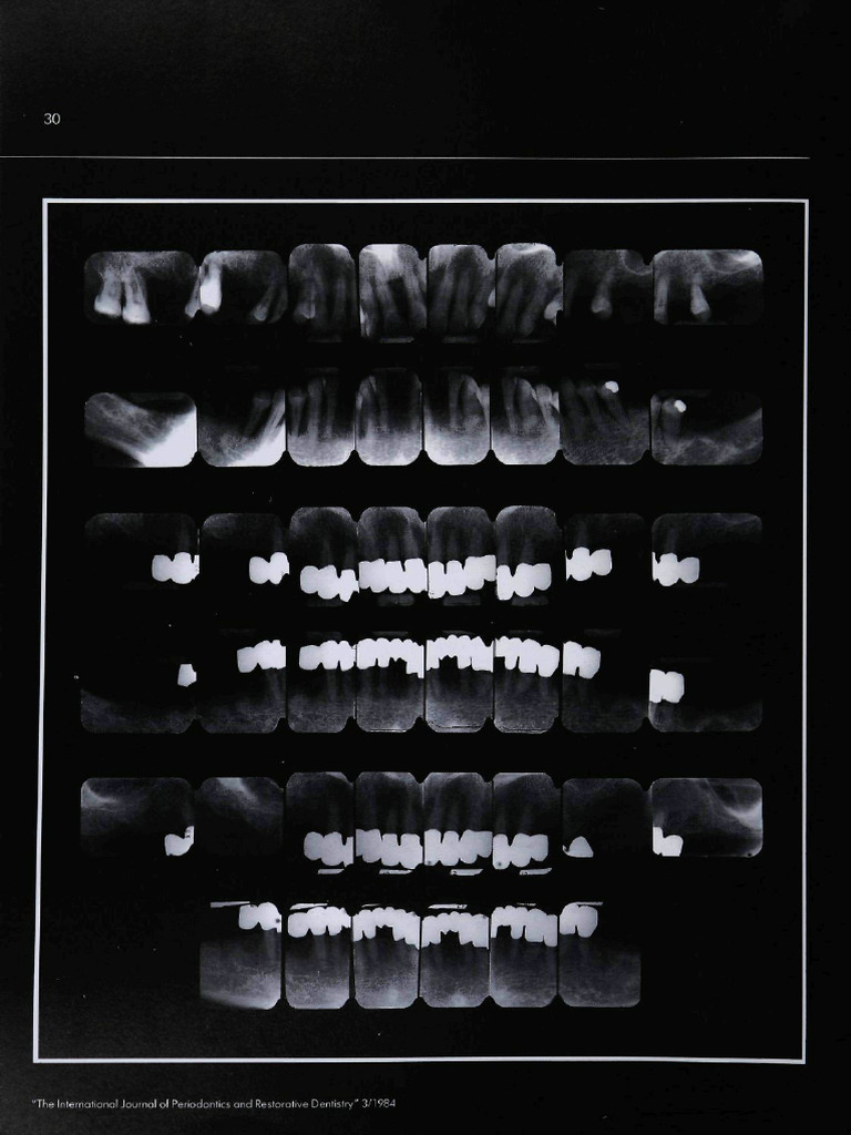 Nevins 그리고 Skurow - 1984 - The Intracrevicular Restorative Margin, the ...