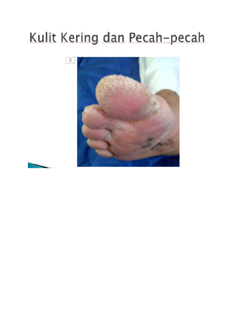 Kkulit Pecah-Pecah Selama Haji | PDF