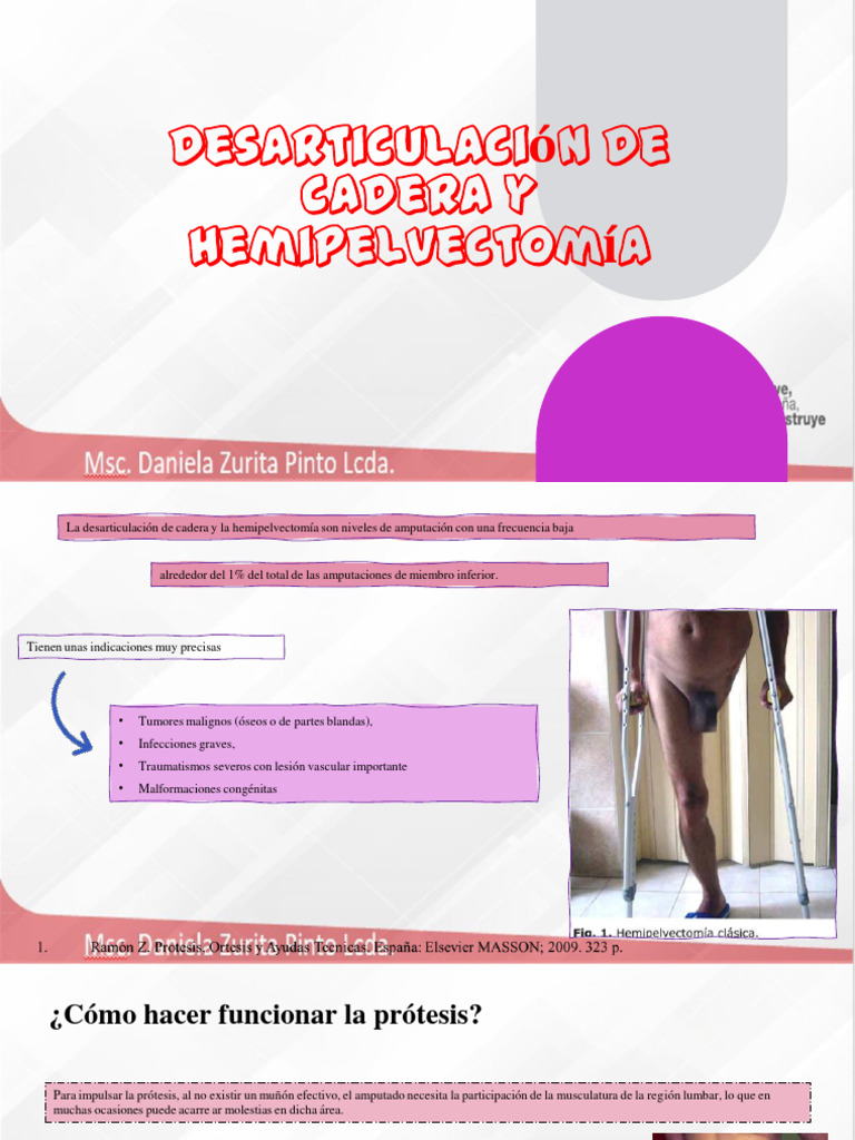 17 Desarticulacion de Cadera | Descargar gratis PDF | Pelvis | Rodilla