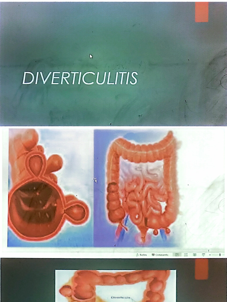 Diverticulitis Surgery | PDF