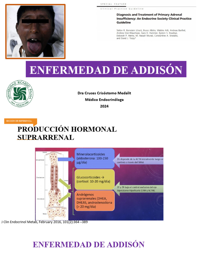 Enfermedad de Addison | PDF | Glándula suprarrenal | Hormona adrenocorticotrópica