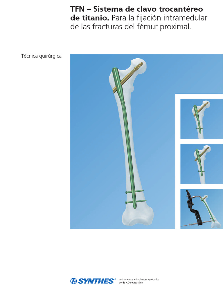 De Las Fracturas Del Fémur Proximal.: TFN - Sistema de Clavo ...