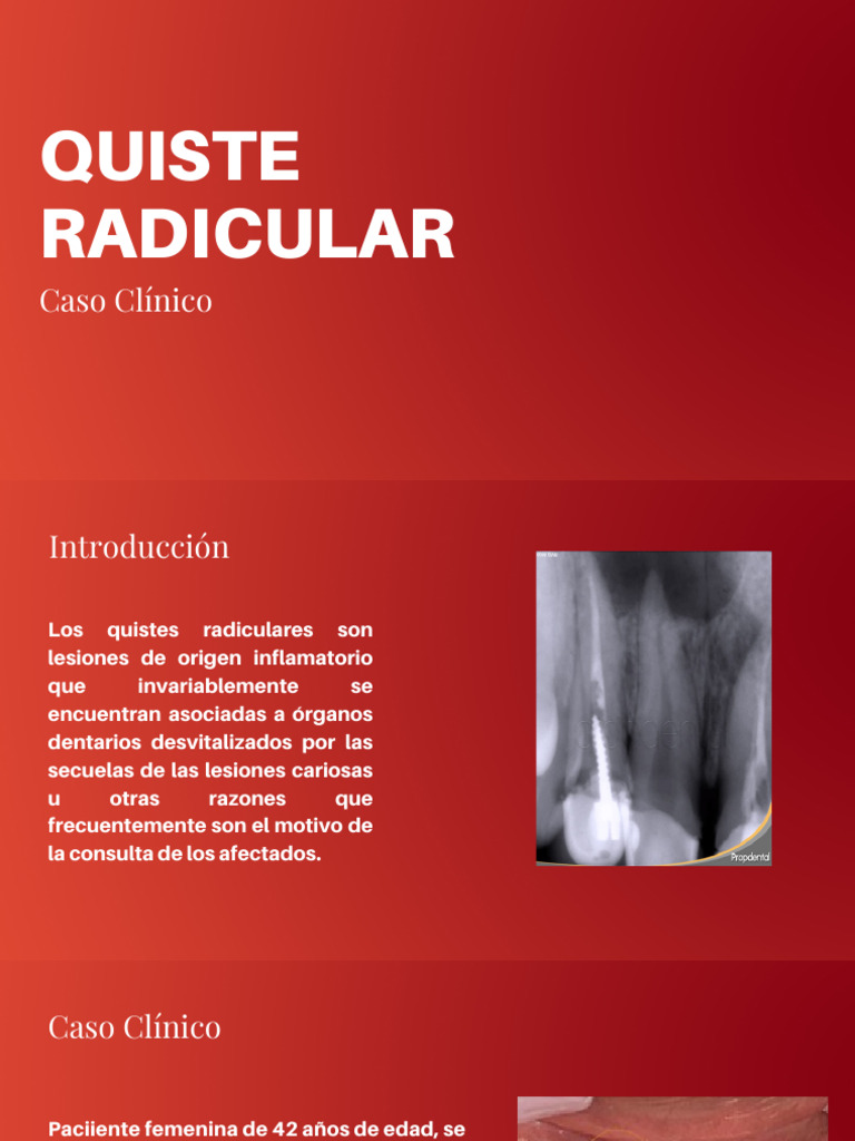 Quiste Radicular: Caso Clínico y Diagnóstico | PDF | Enfermedades y ...