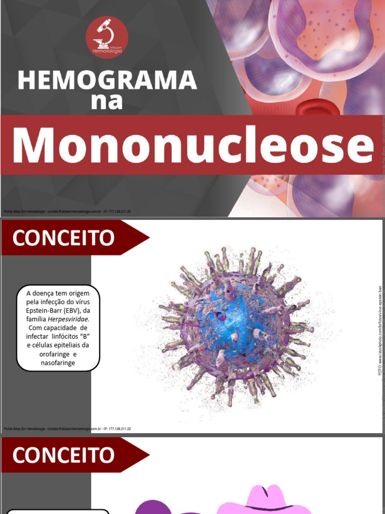 Mononucleose: Sintomas e Diagnóstico | PDF | Linfócito | Especialidades ...