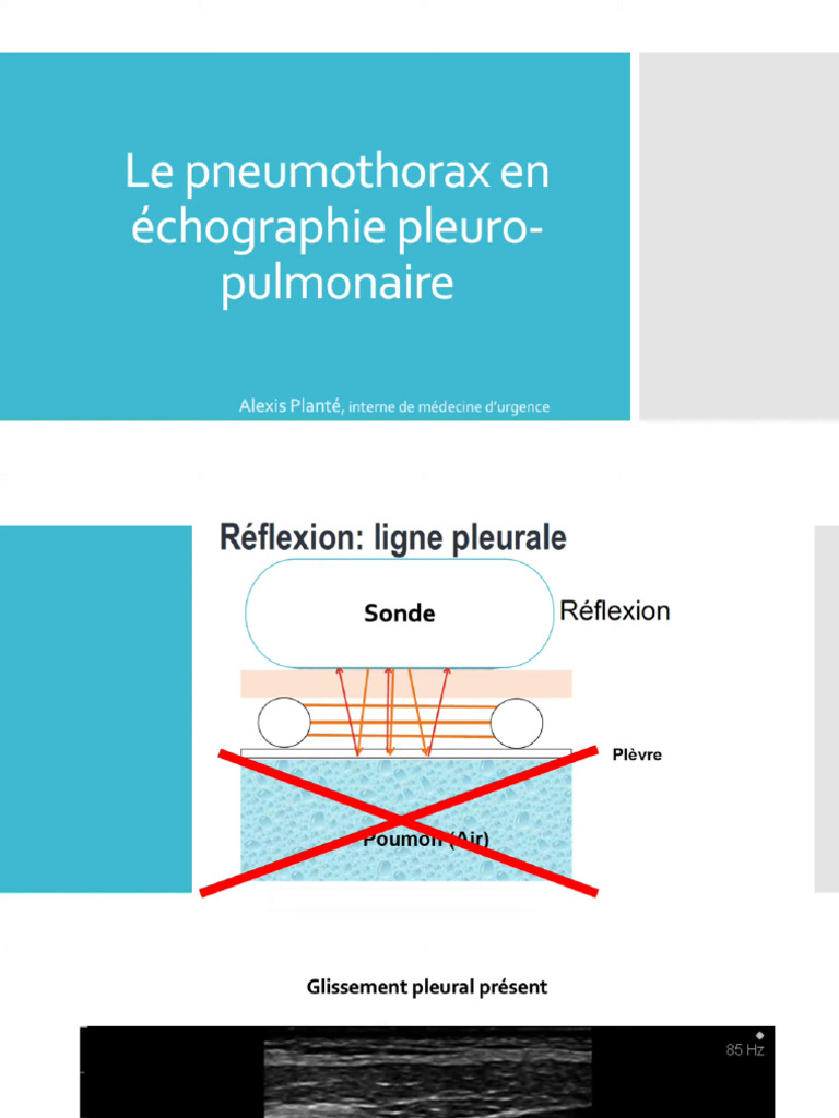 2 Le Pneumothorax en Ã©chographie Pleuro-Pulmonaire | PDF