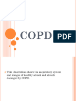 Understanding Chronic Obstructive Pulmonary Disease | PDF | Chronic ...
