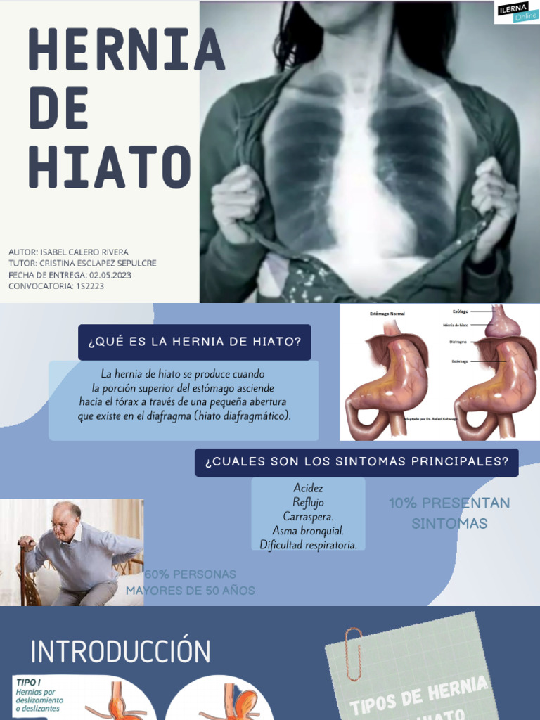 Presentación hernia hiato | PDF