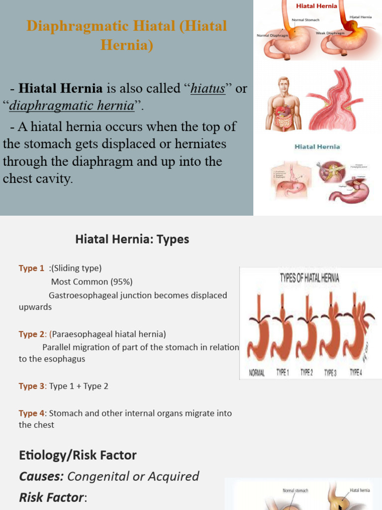 Hiatal Hernia: Types and Management | PDF | Clinical Medicine ...
