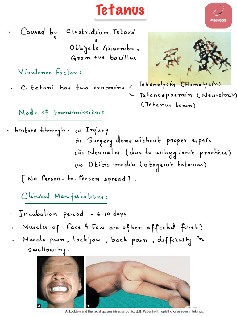 3. Tetanus | PDF | Clinical Medicine | Medical Specialties