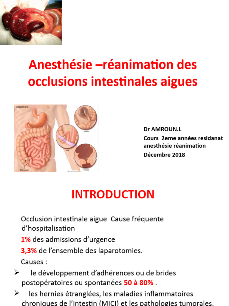 Anesthesie Reanimation Occlusion Intestinale Aigue | PDF | Tractus ...