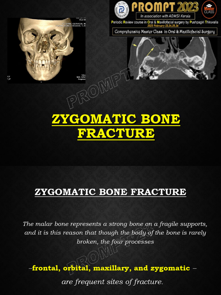 Zygomatic Bone Fracture | PDF | Human Head And Neck | Musculoskeletal ...