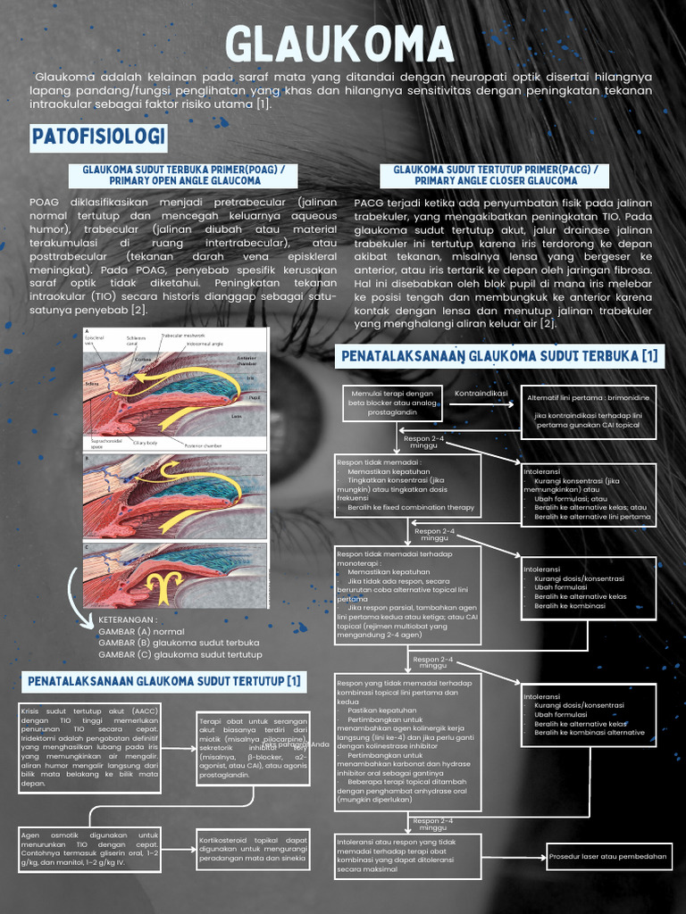 Poster Glaukoma - Apoteker | PDF